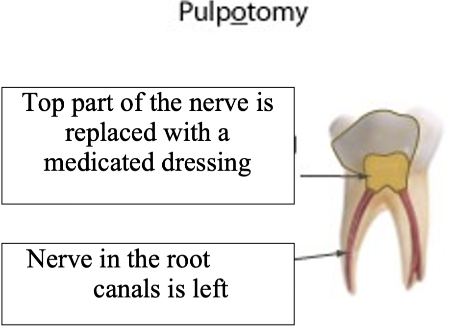 Pulpotomy Pulpotomy Vs Pulpectomy 🦷 Read Our New Blog Post To Learn